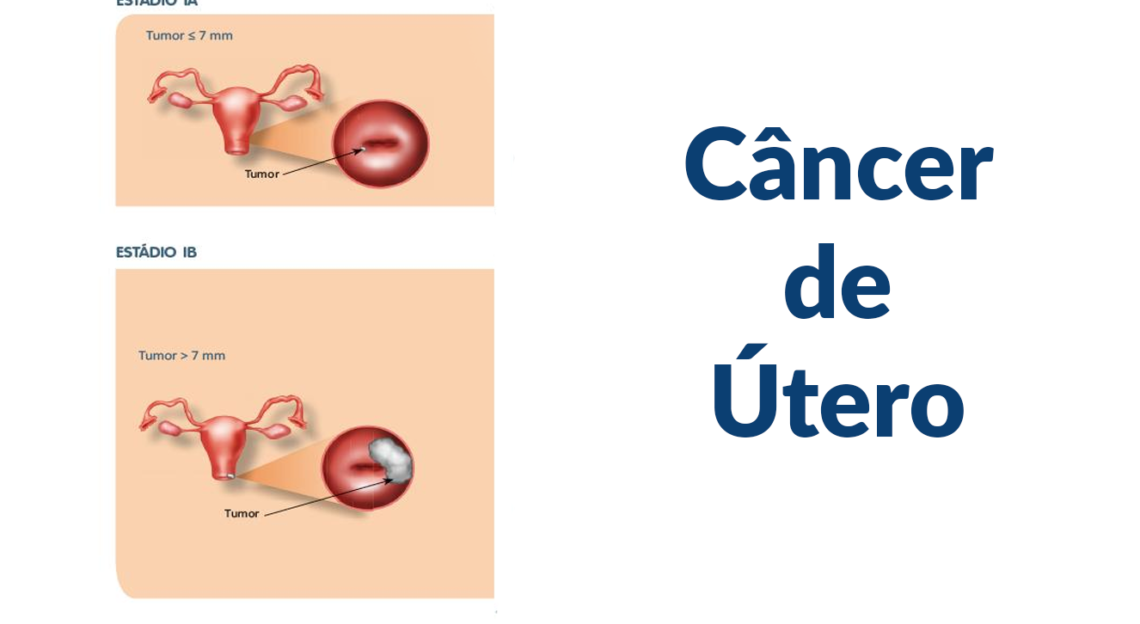Câncer de colo do útero | Tratamento